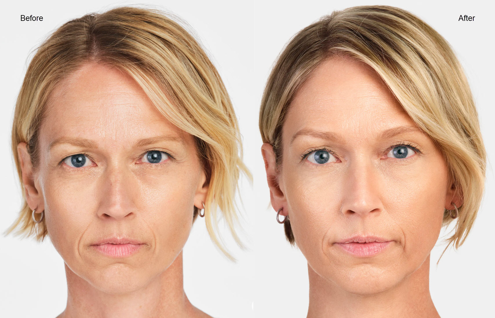 Radiesse Fillers – SkinOvations