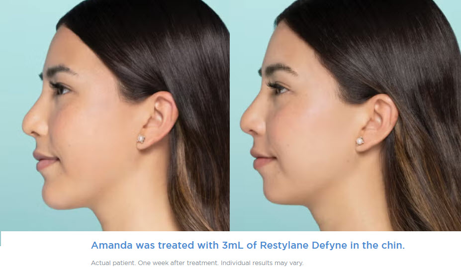 Restylane Fillers – SkinOvations