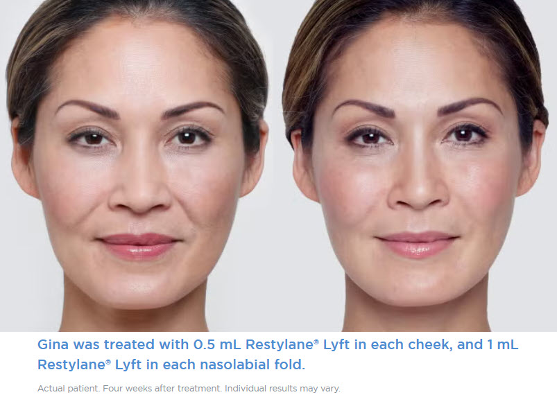 Restylane Fillers – SkinOvations