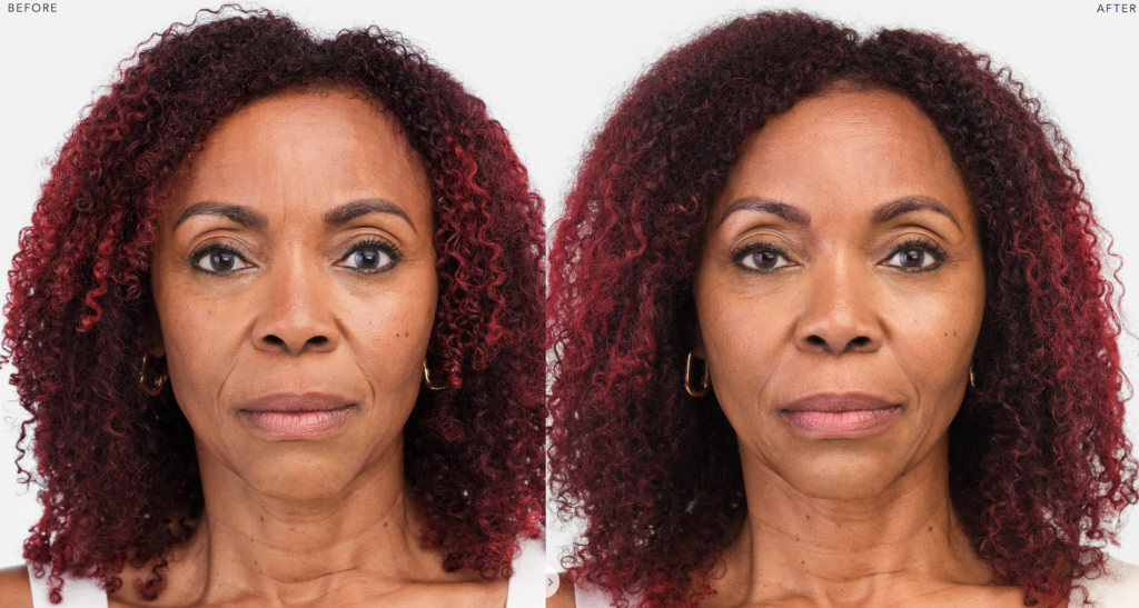 Radiesse Fillers – SkinOvations